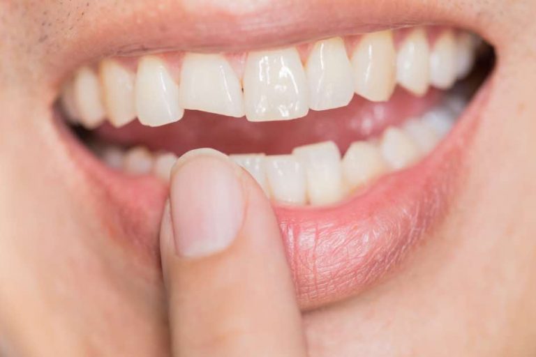 Chipped Tooth? Learn About Your Options From An Emergency Dentist