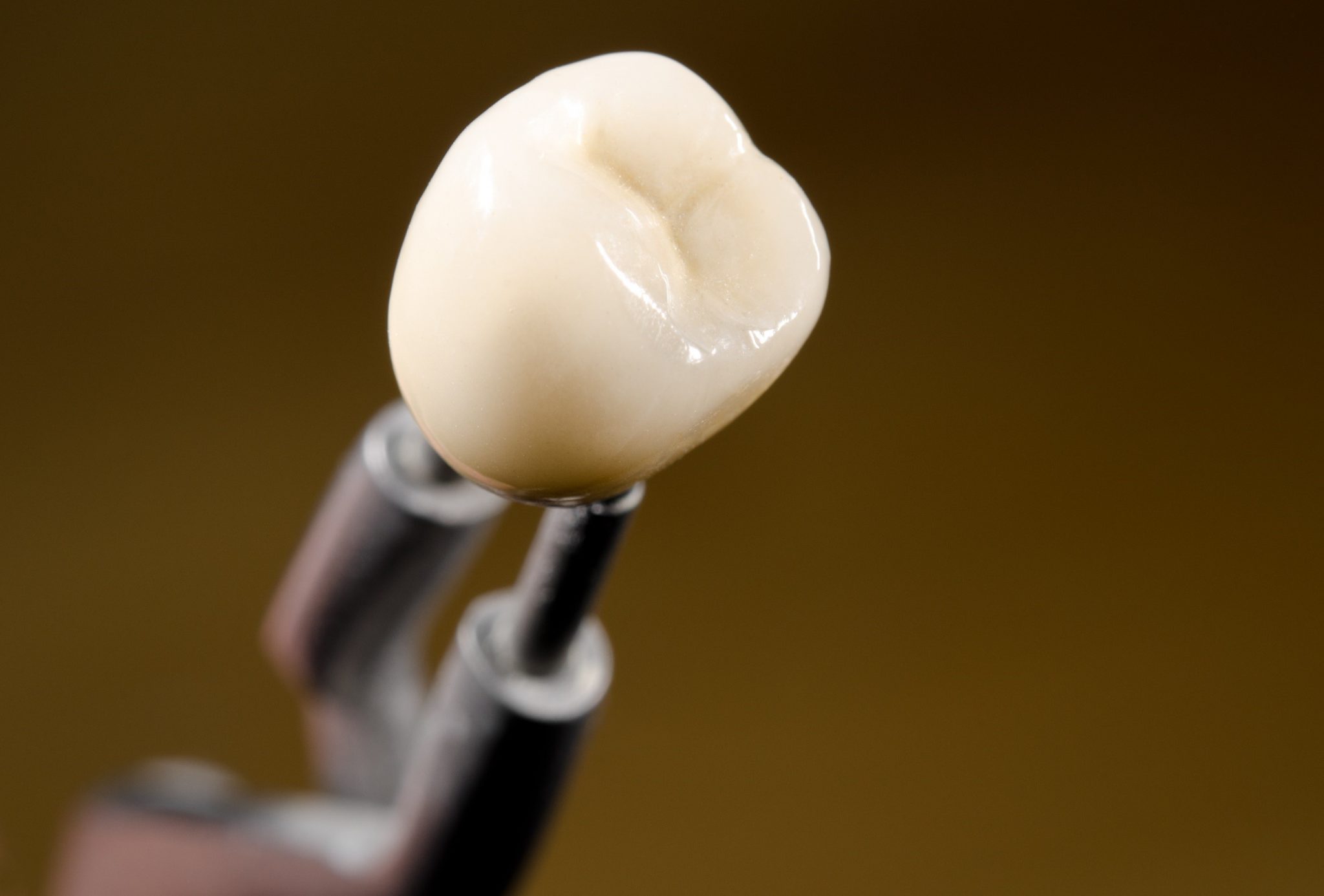 What Causes a Black Line Around a Dental Crown?